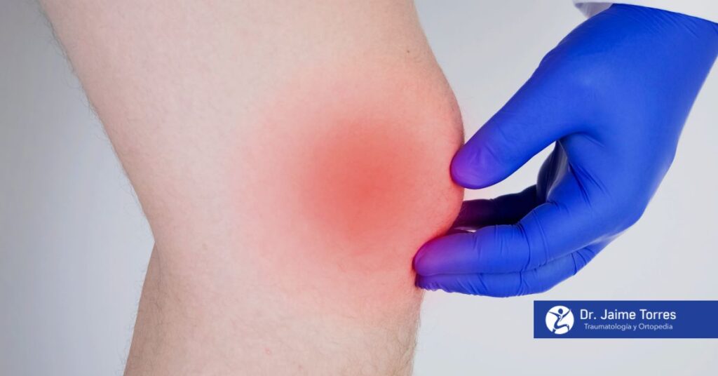 Bursitis Prerrotuliana Rodilla: Bursas En La Rodilla Derecha – RDPI
